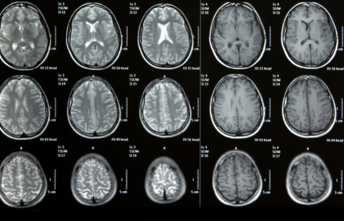 صرع - اکسون‌لایف